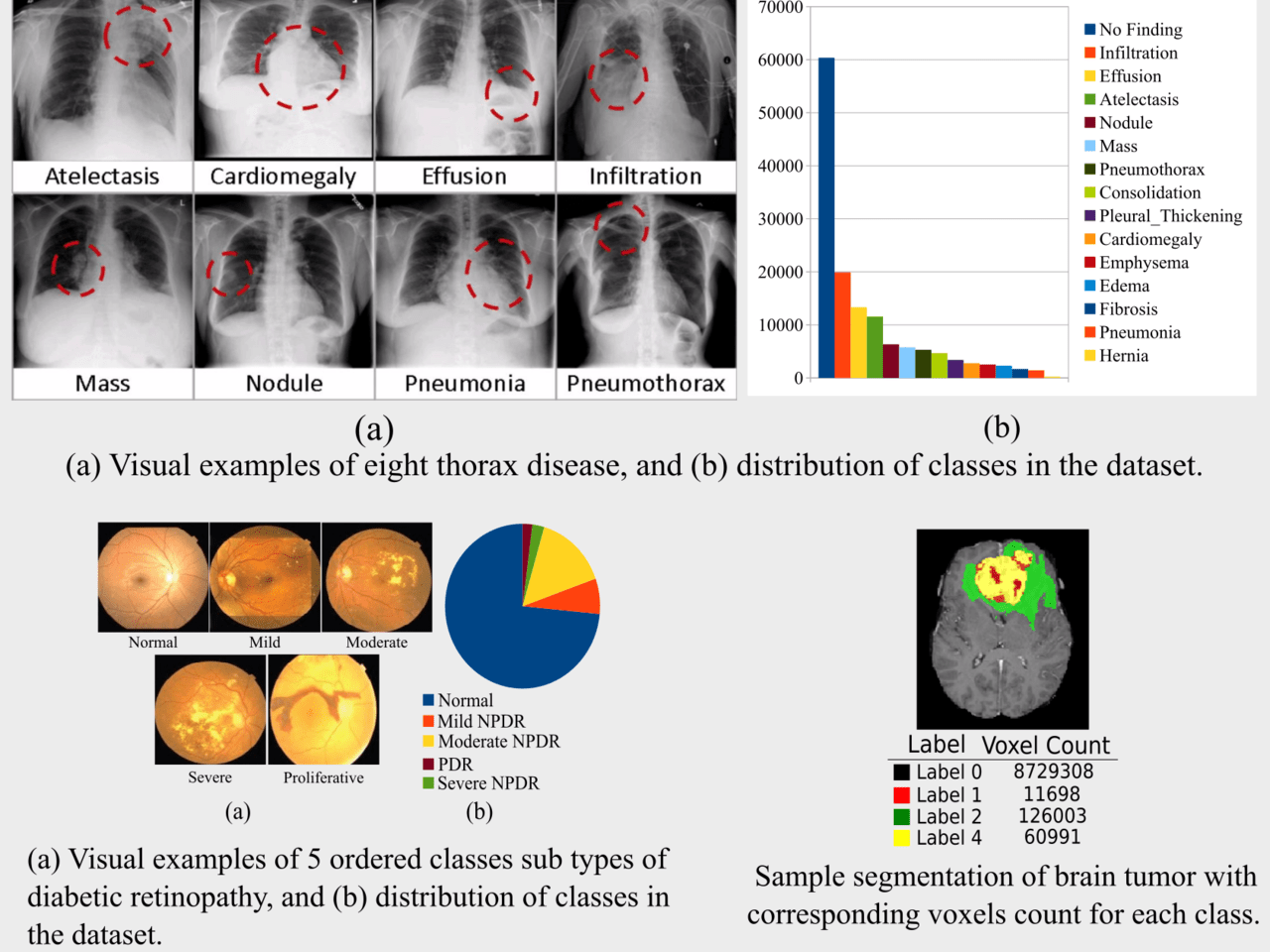 Handling Imbalanced Dataset In Machine Learning Deep Learning Machine Learning With Imbalanced
