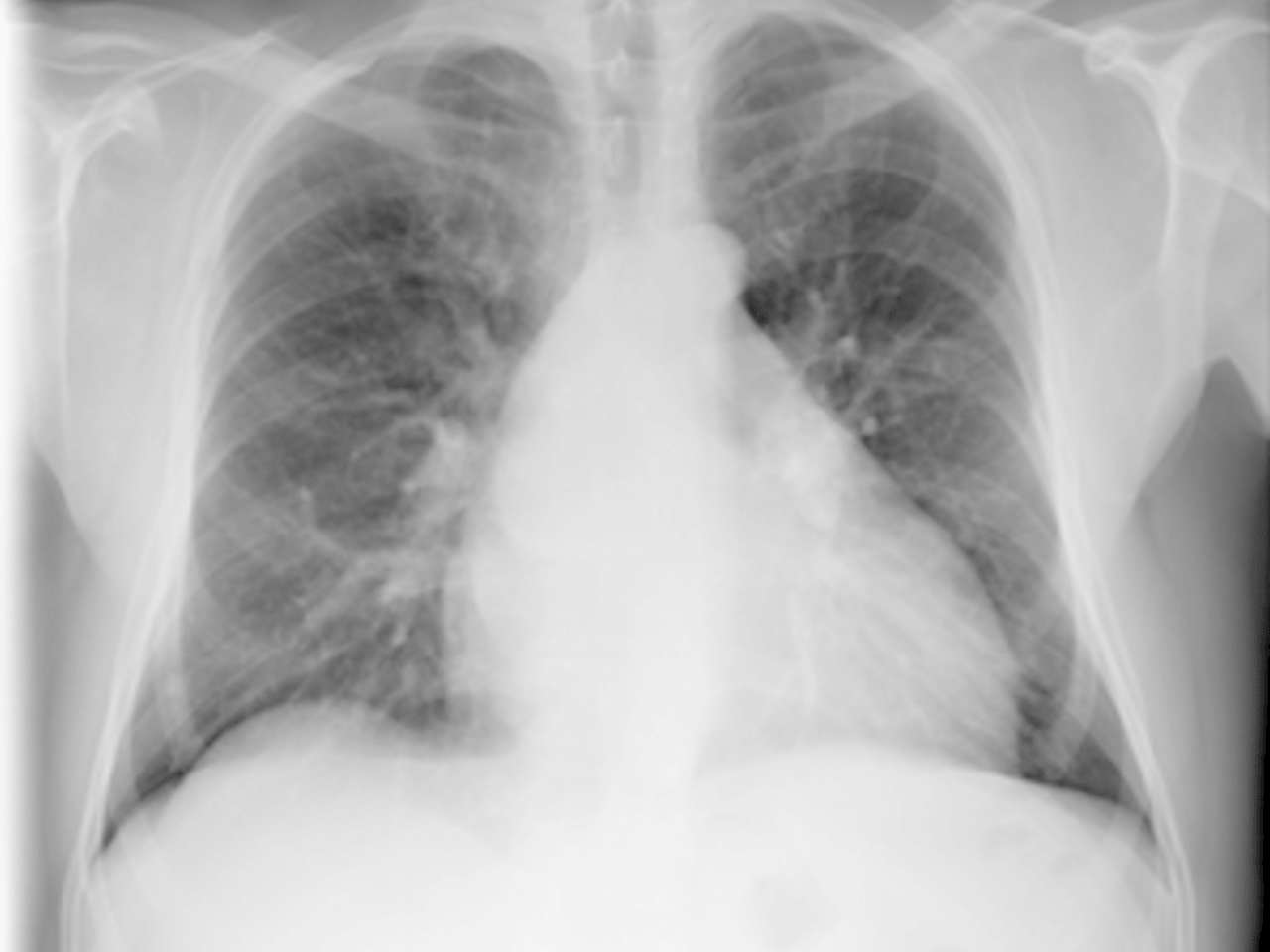 Disease Detection From Chest X Ray Images Using Deep Learning Intel Devmesh