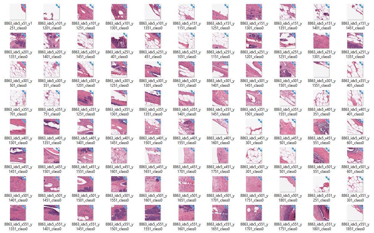 Breast Cancer Detection Using Computer Vision & IoT | Intel DevMesh ...