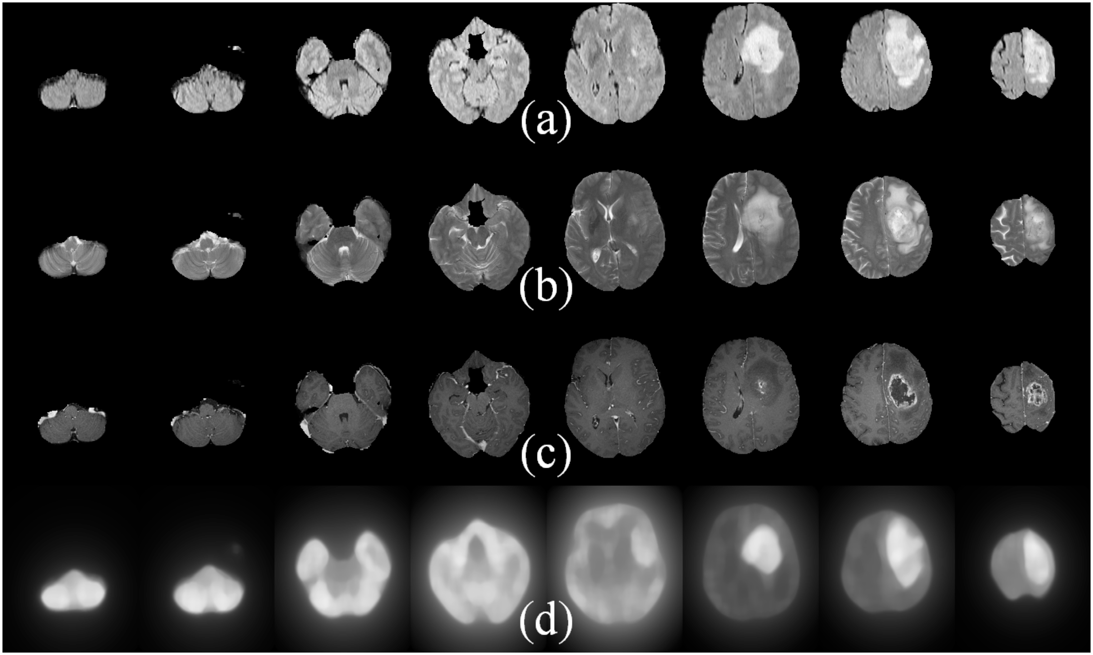 Volumetric brain tumour detection from MRI using visual saliency ... Volumetric brain tumour detection from MRI using visual saliency ...