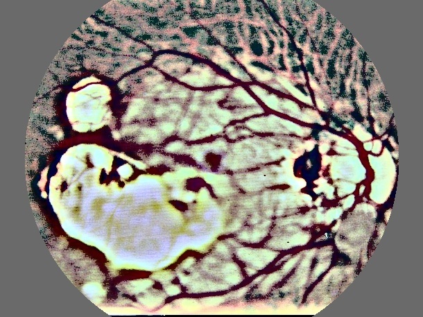 Diabetic Retinopathy Clasification Using Convolutional Neural Networks