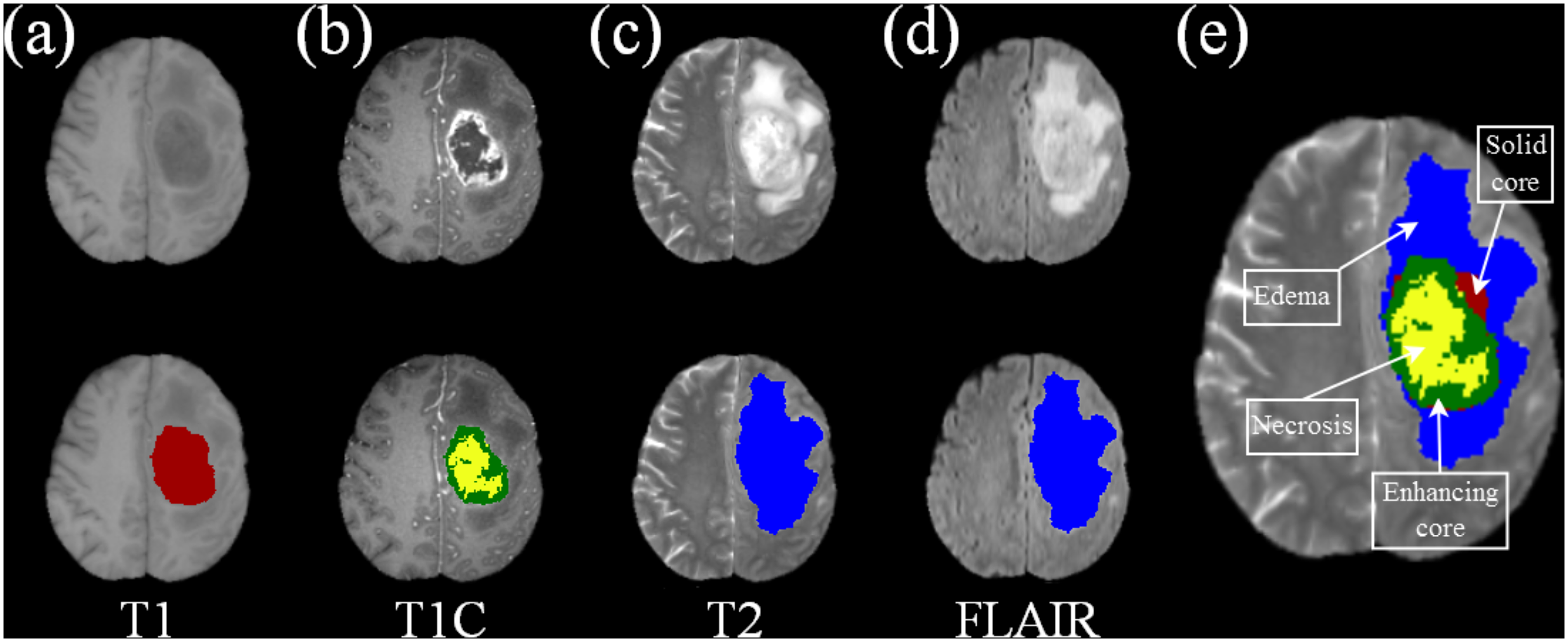 Volumetric brain tumour detection from MRI using visual saliency ... Volumetric brain tumour detection from MRI using visual saliency ...