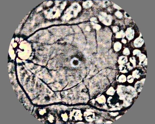 Diabetic Retinopathy Clasification Using Convolutional Neural Networks