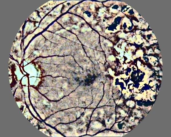 Diabetic Retinopathy Clasification Using Convolutional Neural Networks