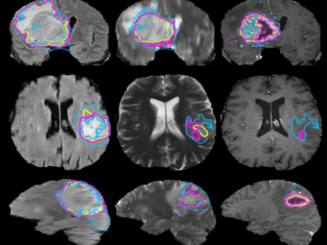 Brain Tumor Segmentation With Conditional Random Fields Intel Devmesh